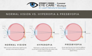 Everything You Need to Know About Presbyopia | Stoney Creek