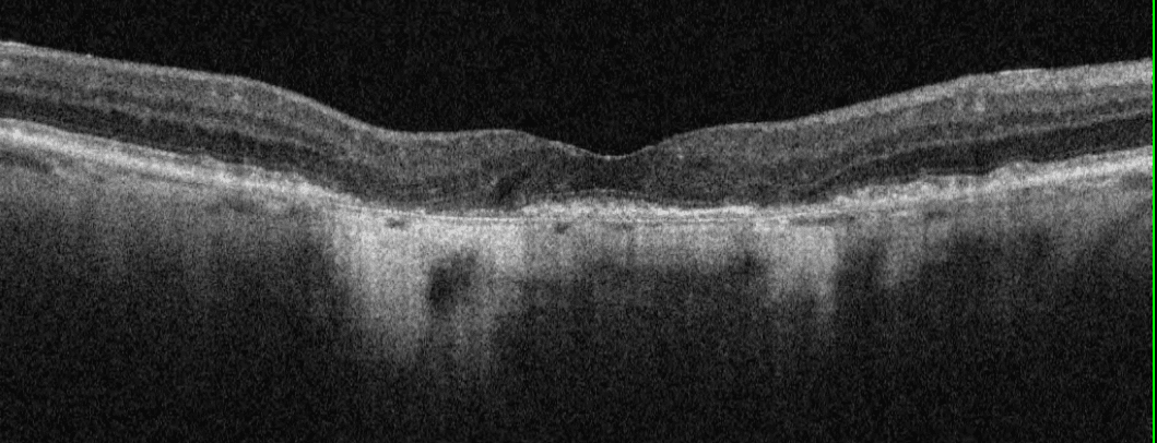 What is Optical Coherence Tomography (OCT)?